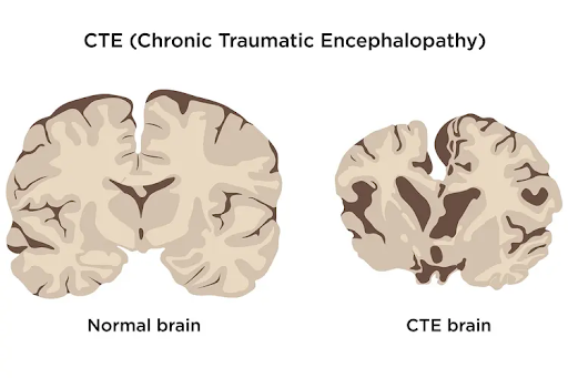 Exploring Chronic Traumatic Encephalopathy (CTE): What are the Risks?